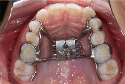 Expansor de Williams: passo a passo – MarketPlena